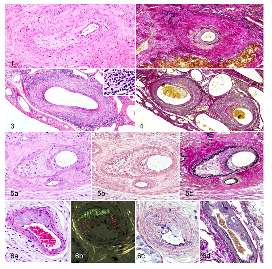 Age-related arteriolar changes with lipid and amyloid deposits in the ...
